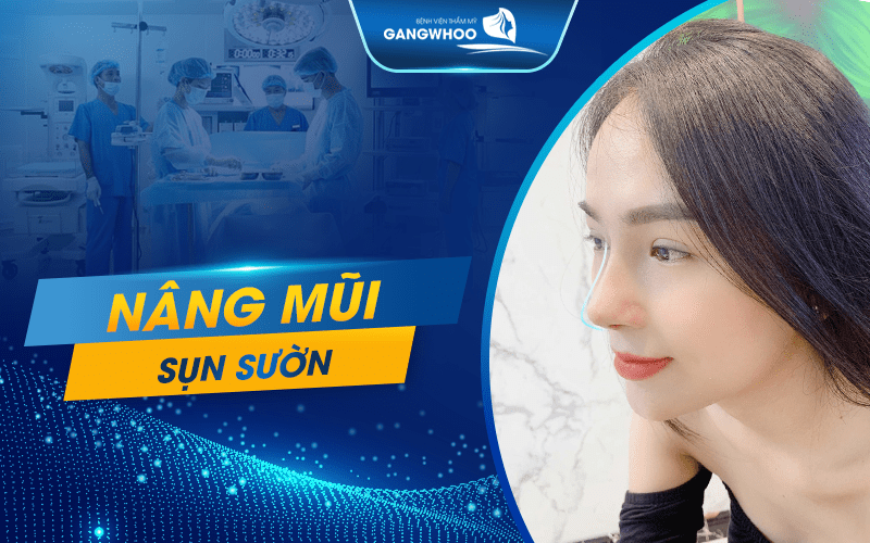 Nâng Mũi Sụn Sườn - Phương Pháp Nâng Mũi Đẹp Hoàn Hảo