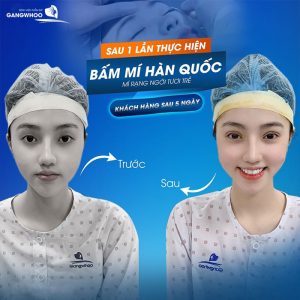 BẤM MÍ HÀN QUỐC, MẮT ĐẸP THẦN TỐC CHỈ TRONG 20-30p