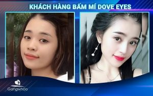 BẤM MÍ DOVE EYES, THỔI HỒN CHO ĐÔI MẮT ĐẸP LONG LANH