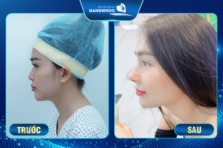 Nâng mũi lấy sụn tai có tốt không? Những thông tin từ chuyên gia