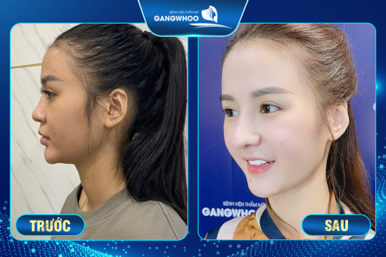 Nâng mũi lấy sụn tai có tốt không? Những thông tin từ chuyên gia